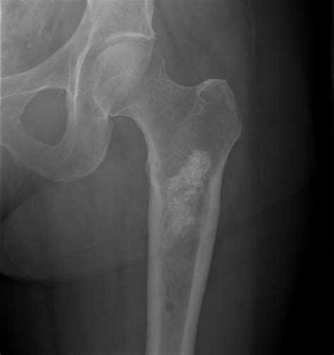 Chondrosarcoma The Bone School