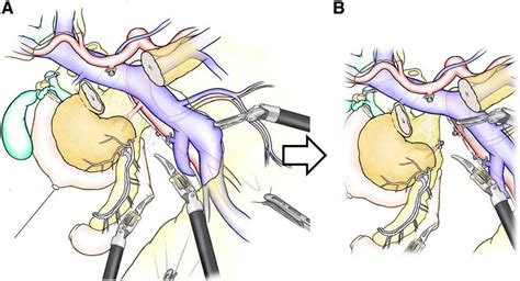 Schema Of The Right Position A The Proximal Jejunum Is Divided And Download Scientific