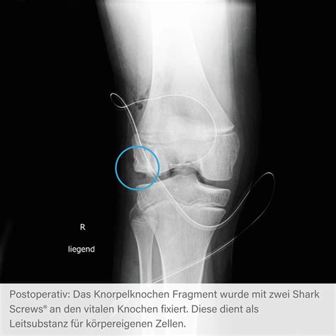 Osteochondrosis Dissecans Cause Treatment Surgery