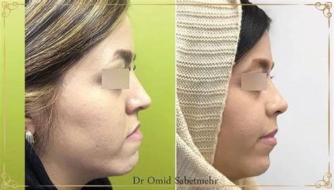 جراحی فک و صورت دکتر امید ثابت مهر جراح فک و زیبایی صورت