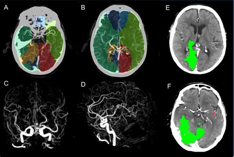 Right Pca Occlusion Occluded Pre Communicating Segment P1 Of The Download Scientific Diagram