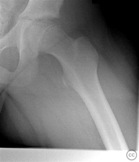 Scfe Longitudinal Images Over 6 Years 10 16years Old