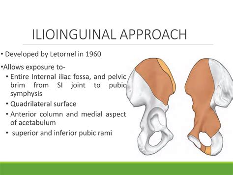 Surgical Approaches To Acetabulum And Pelvis Pptx