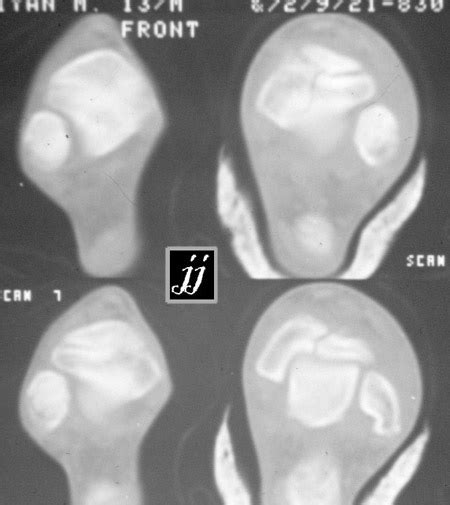 Msk Distal Tibial Fracture Radioogle