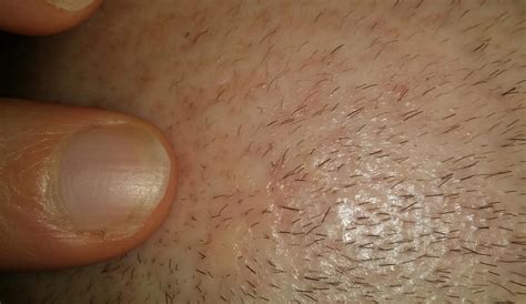 Strange Bumps On Scalp R Dermatology