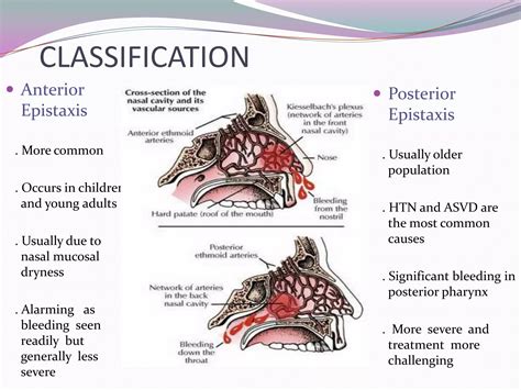 Epistaxis Pptx