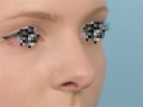 Before And After Rhinoplasty Houston Face Forward