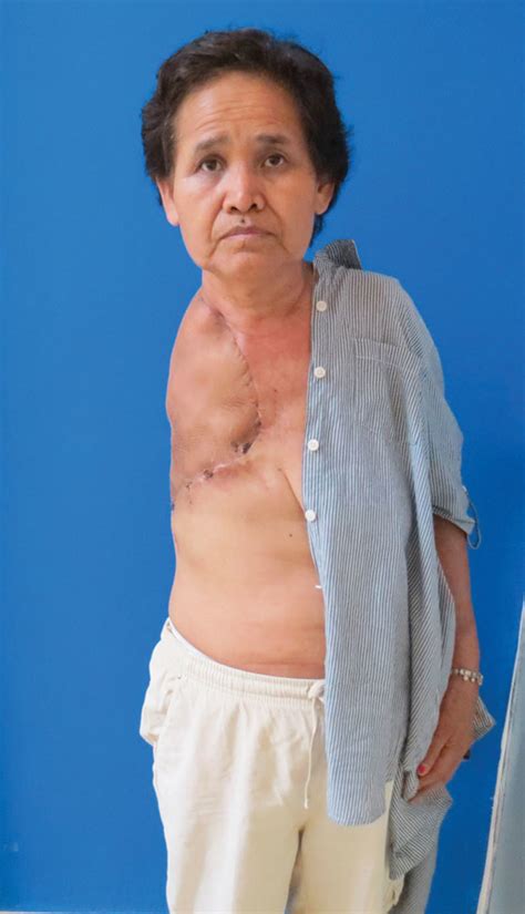 Bilateral Forequarter Amputation