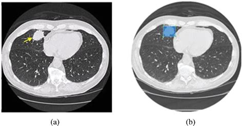 Figure 3 From Lung Nodule Detection Based On Yolov3 Deep Learning With Limited Datasets