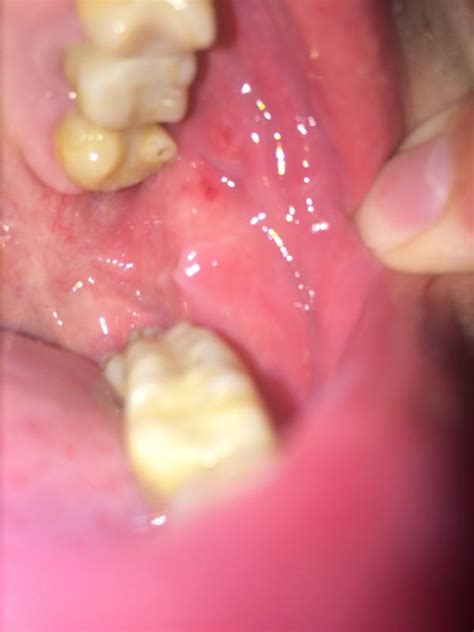 Ответы Mail Две язвы во рту не болят СИФИЛИС