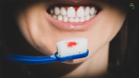 ПАРОДОНТИТ ВЪЗПАЛЕНИЕ И КЪРВЕНЕ НА ВЕНЦИТЕ Дентална практика д р Диана Бонова Хасково