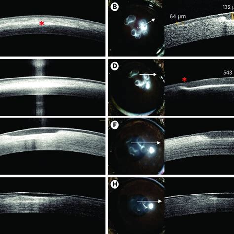 Slit Lamp Photographs And The Corresponding Sd Oct Scans With Corneal