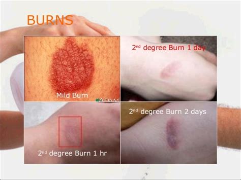 2nd Degree Burn Healing Stages Gangder