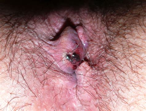 What Does A Hemorrhoid Look Like When It Pops At Emma Lowell Blog