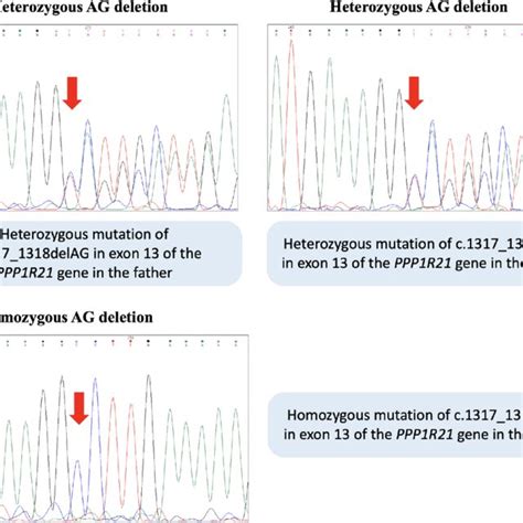 Sequencing Chromatogram Of Genomic Dna Showing C 1317 1318delag