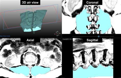 Three Dimensional Segmentation Of The Lumbar Extensor Muscle Download