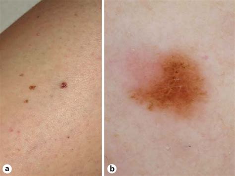 Melanoma Wide Excision At Ben Waterbury Blog