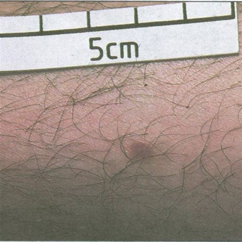 Nodular Kaposis Sarcoma Of Hailux Download Scientific Diagram
