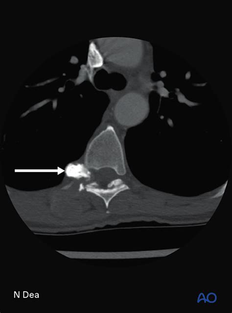 En Bloc Resection Of A Posterior Tumor T1 To T12 For Benign Thoracic