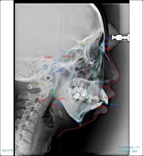 Class Ii Skeletal Malocclusion With Great Value Of Anb Go2 And Yaxis Sn Download Scientific