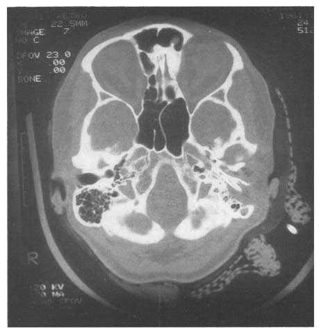 CT Scan Of The Middle Ear With The Afterloading Probe In Situ Download Scientific Diagram