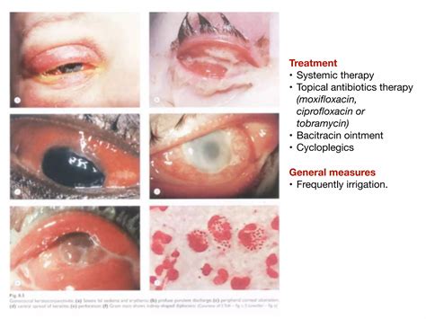 Conjunctivitis Pdf