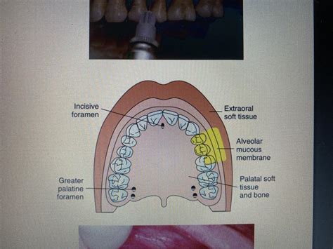 Maxillary Nerve Block High Tuberosity Approach
