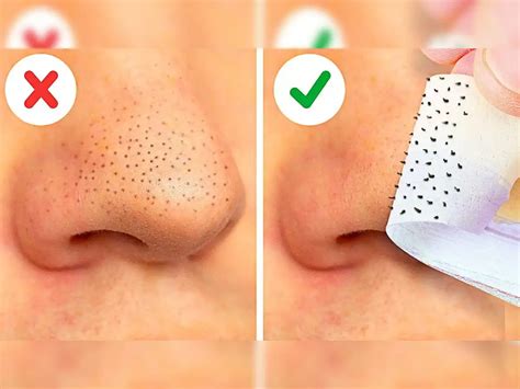 What To Apply After Removing Blackheads At Alyssa Wekey Blog