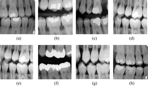 Input Dental Caries Image Row 1 A Sample 7 B Sample 8 C Sample 9 Download Scientific