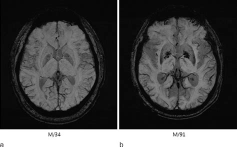 Lentiform Nucleus Mri