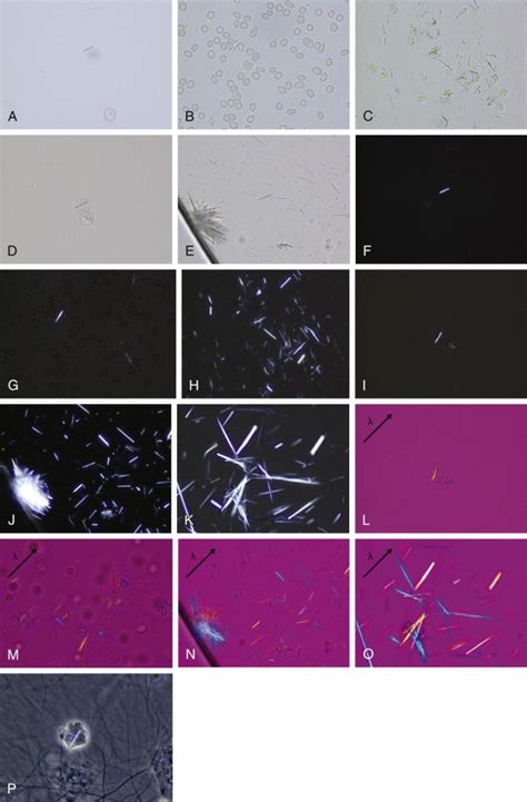 Synovial Fluid Crystal Analysis Musculoskeletal Key