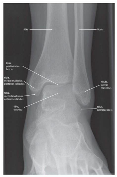 Distal Tibiofibular Joint X Ray