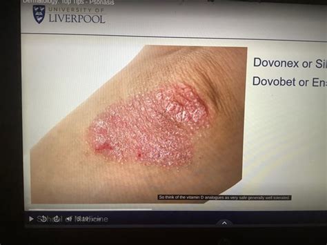 18 Dermatology Top Tips Flashcards Quizlet