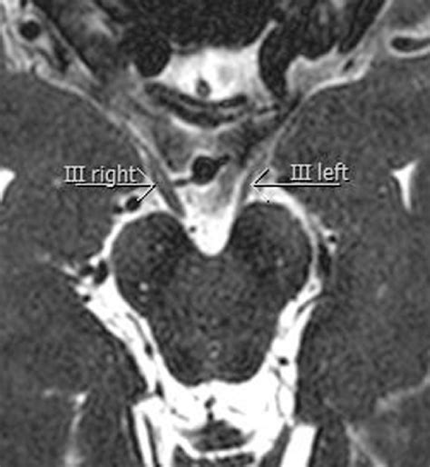 E Transverse 3d T2w Mr Image With Thickened Cisternal Segment Of Right Download Scientific