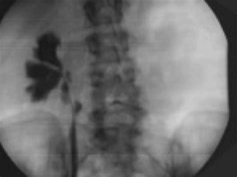 Preoperative Retrograde Pyelogram 4 Cm Proximal Ureteral Stricture