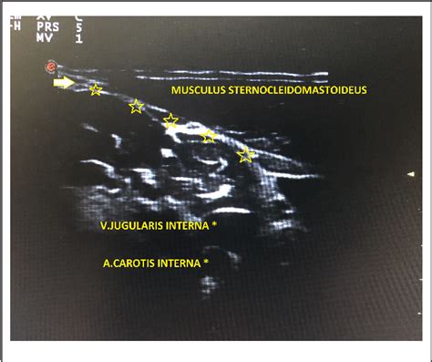 [pdf] Superficial Cervical Plexus Block For Retro Auricular Mass Excision In A Patient With High