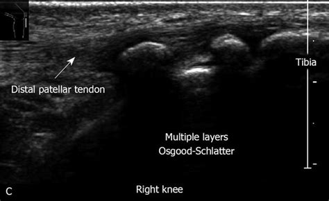 Tibial Tuberosity Apophysitis Wikism Sports Medicine Wiki