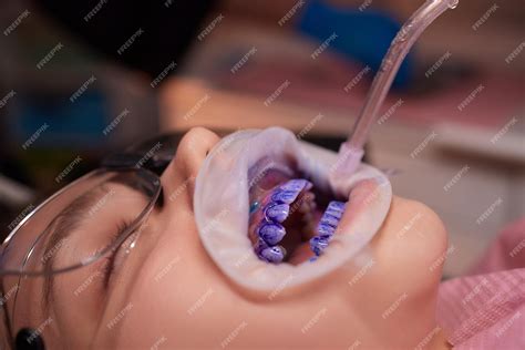 Premium Photo Plaque Indicator On Human Teeth With Braces Plaque Is