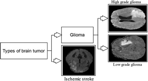 Brain Tumor Types Low Grade Glioma High Grade Glioma Arunkumar Et