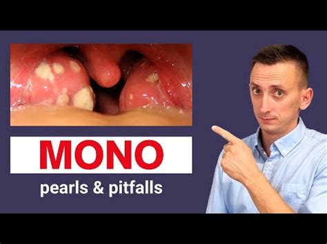 How To Get Rid Of Swollen Tonsils From Mono