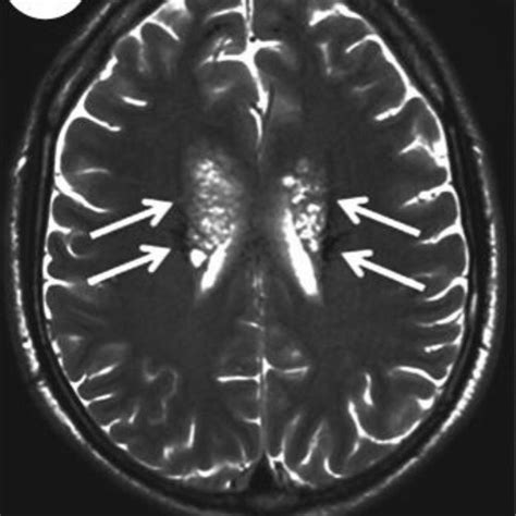 Cryptococcus Brain Cryptococcus Brain