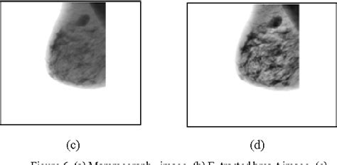 Figure 6 From Breast Segmentation Using K Means Algorithm With A Mixture Of Gamma Distributions