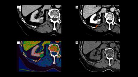 Inside An Incidental Solid Renal Mass Siemens Healthineers