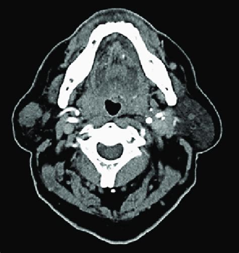 Axial Section Of Contrast Enhanced Computed Tomography Scan Showing Download Scientific Diagram