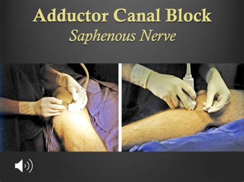 Lower Extremity Adductor Canal Saphenous Nerve Approach For Lumbosacral Plexus Block Flashcards