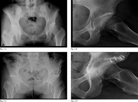 Periacetabular Osteotomy And Combined Femoral Head Neck Junction Osteochondroplasty Semantic