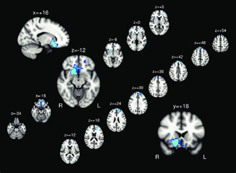 Anterior Piriform Connectivity Regions That Showed Significantly Download Scientific Diagram