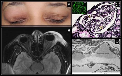 Clinical Images Dacryoadenitis As The Herald Symptom For Systemic Lupus Erythematosus