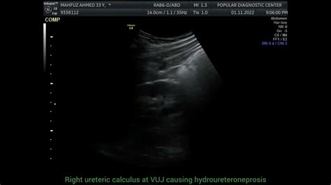 Right Ureteric Calculus At Vuj Youtube