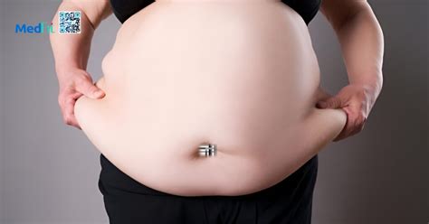 Các Phương Pháp Chẩn đoán Béo Phì